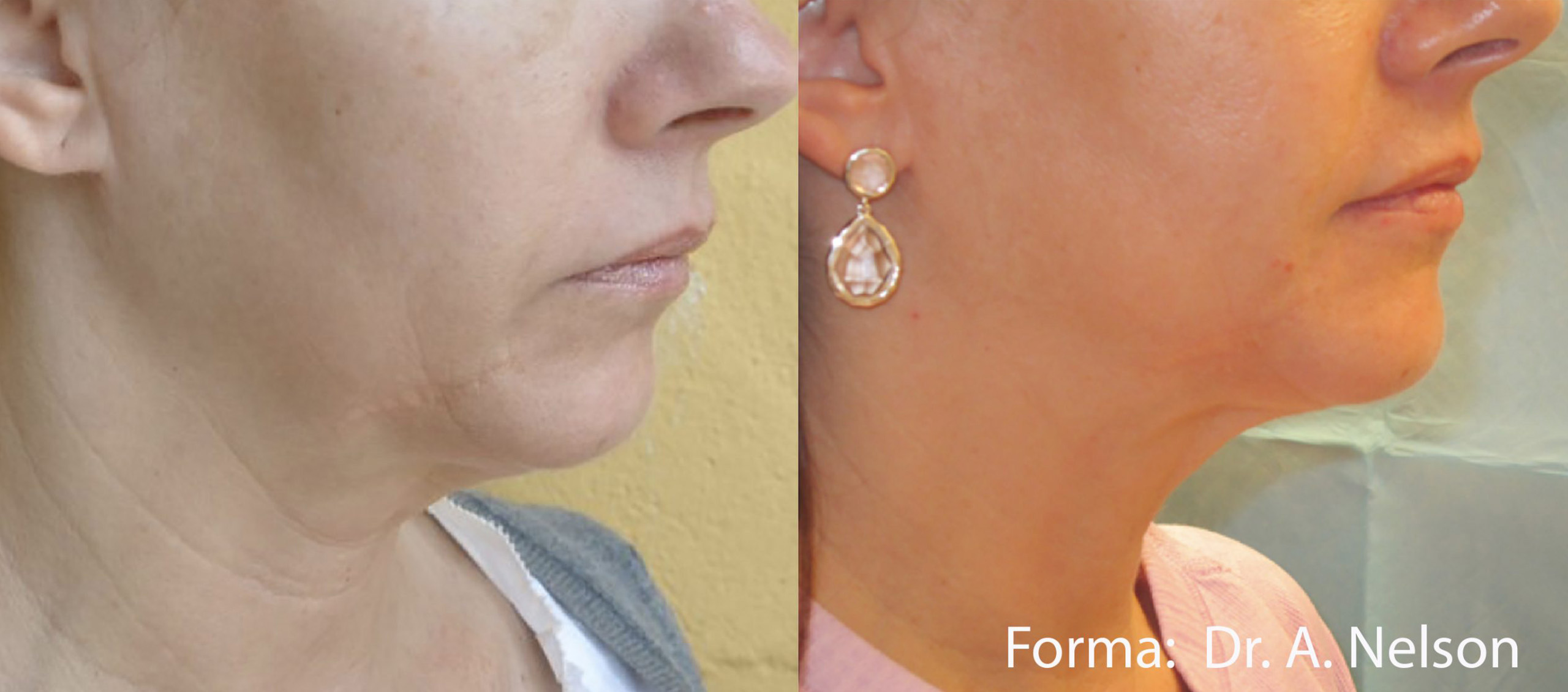 Forma Skin Tightening | Valley Medical Weight Loss
