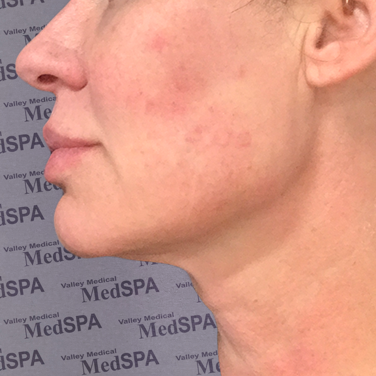 PDO Thread Lift Non-Surgical Phoenix Metro | Valley Medical