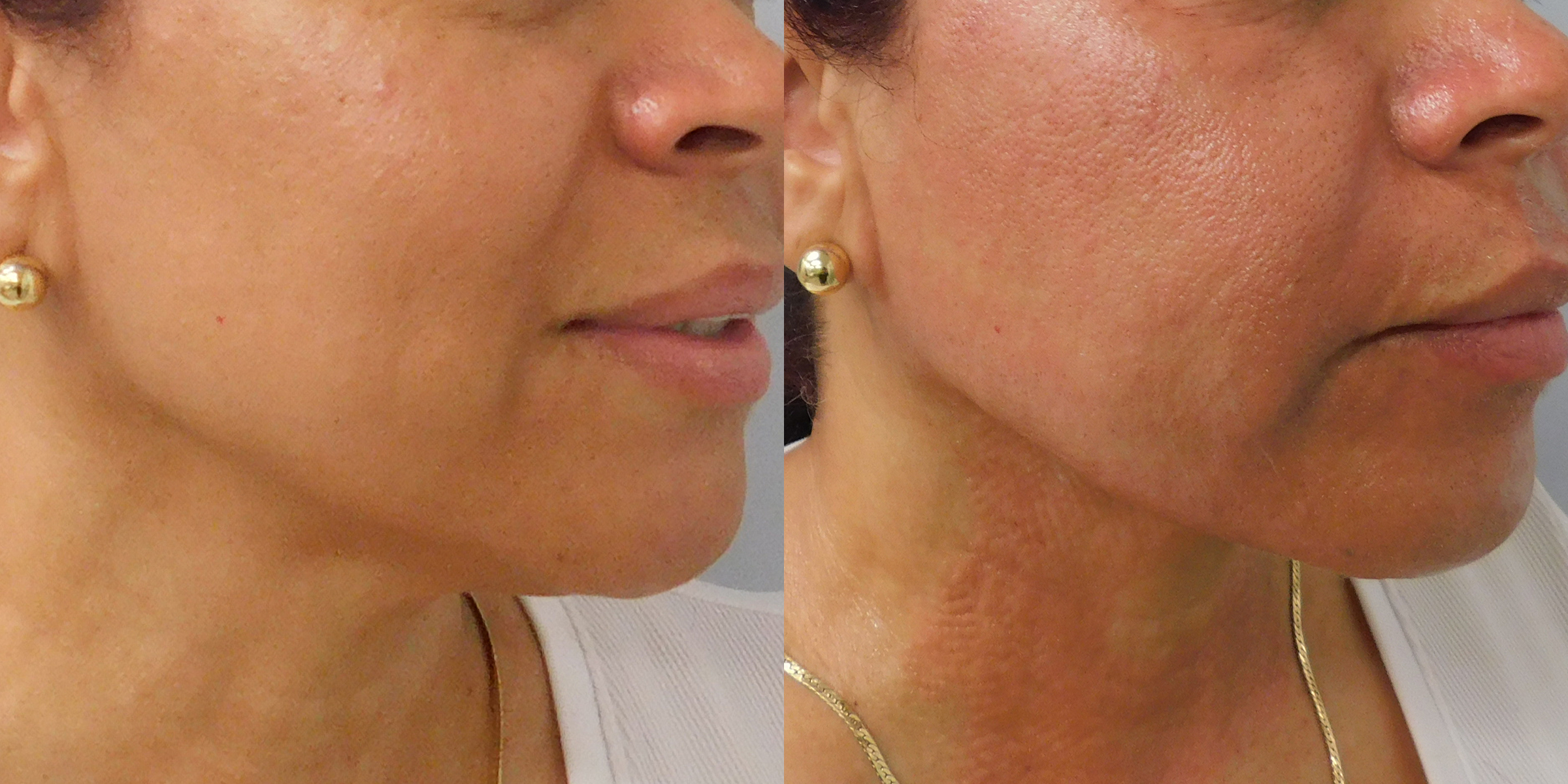 Morpheus8 in Phoenix, AZ | Tempe & Glendale Morpheus8 Treatment