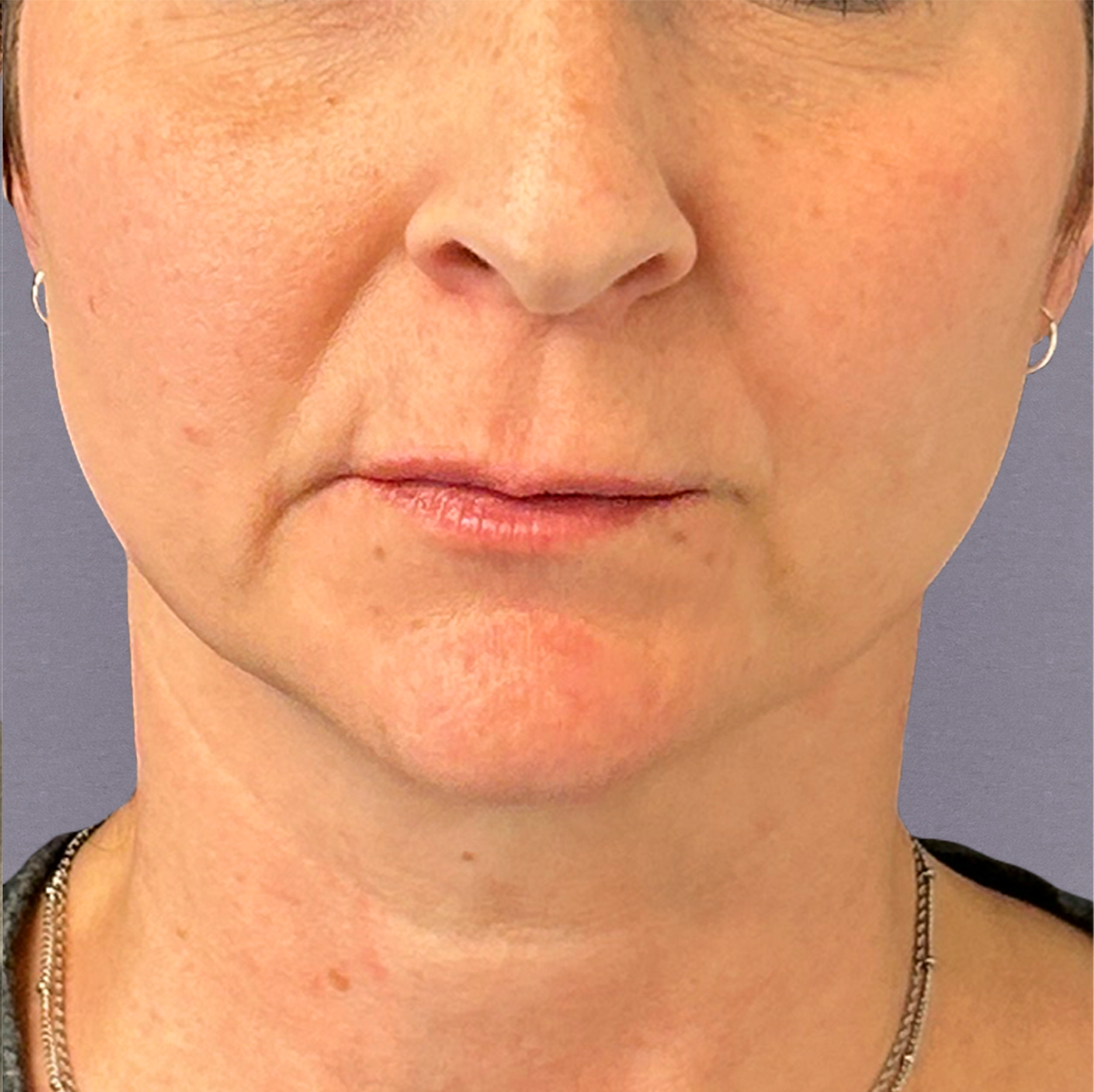 PDO Thread Lift Non-Surgical Phoenix Metro | Valley Medical