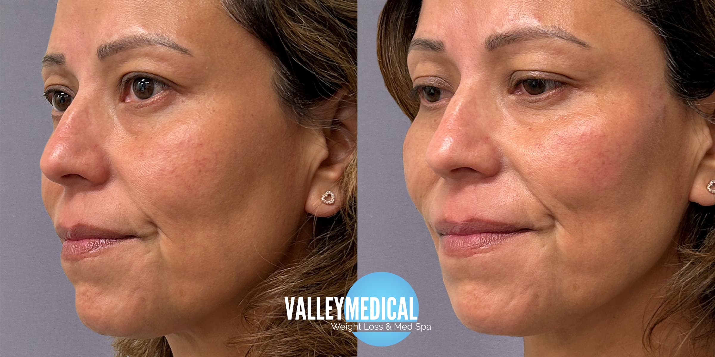 Sculptra in Phoenix, AZ | Valley Medical Weight Loss