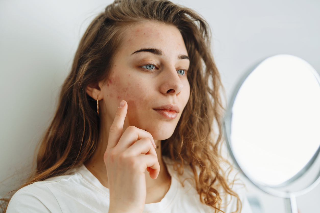 What Causes Adult Acne And How To Treat It Blog Valley Medical