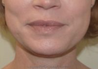Mandible Contouring Before & After Photos | The Spiegel Center