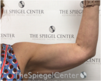 Bodytite Before & After Photos | The Spiegel Center
