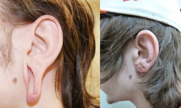 What Causes Fat Earlobes