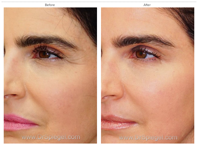 Smooth and Tight: Beautiful Lower Eyelids Chestnut MA