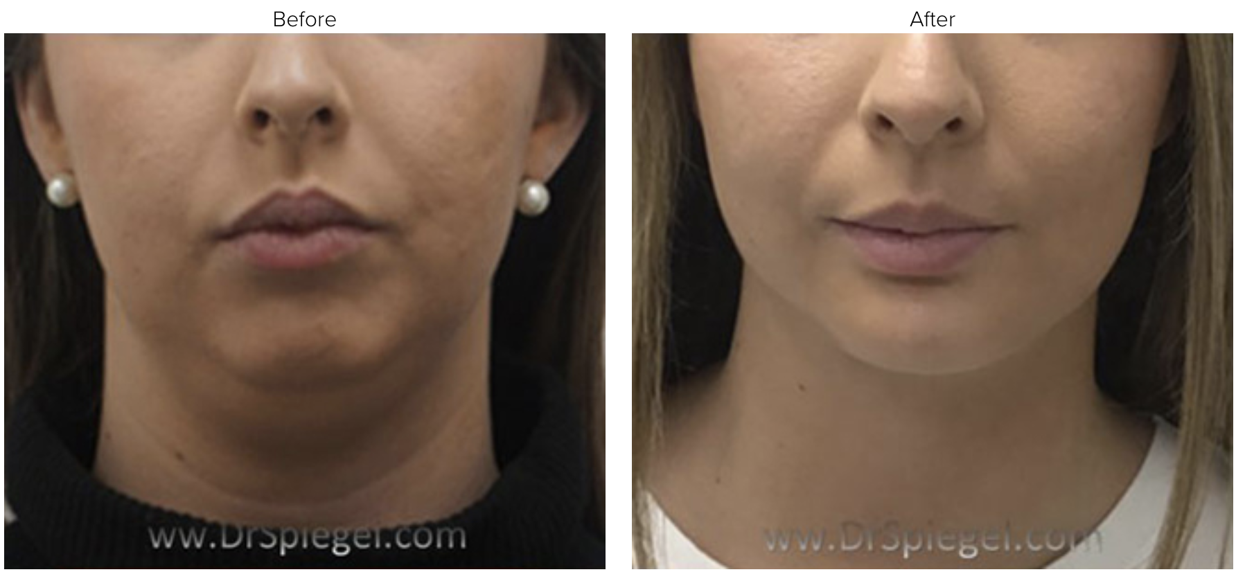 Cleft Chin Before And After
