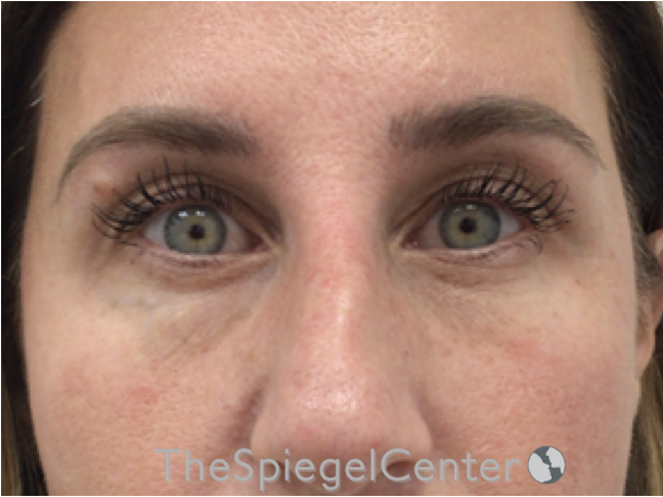 Temple Filler Before & After Photos | The Spiegel Center