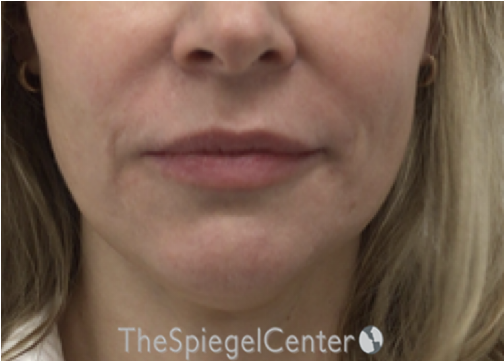 Patient 258322 | Nasolabial Fold Filler Before & After Photos | The ...