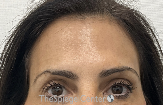 Browlift / Fox Eye Lift Before & After Photos | The Spiegel Center