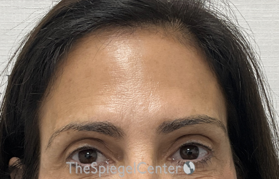 Browlift / Fox Eye Lift Before & After Photos | The Spiegel Center