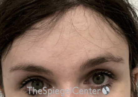 Browlift / Fox Eye Lift Before & After Photos | The Spiegel Center