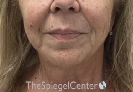 Chin Augmentation Before & After Photos | The Spiegel Center