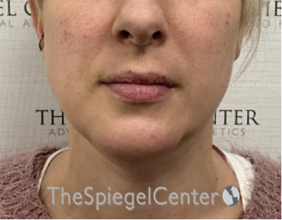 Chin Augmentation Before & After Photos | The Spiegel Center