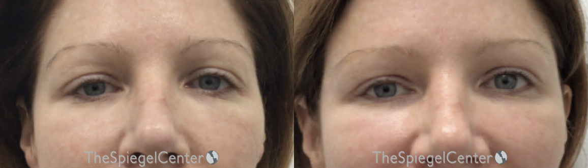 Temple Filler Before & After Photos | The Spiegel Center