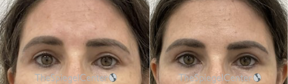 Temple Filler Before & After Photos | The Spiegel Center