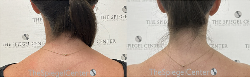 Trapezius Botox (TrapTox) Before & After Photos | The Spiegel Center