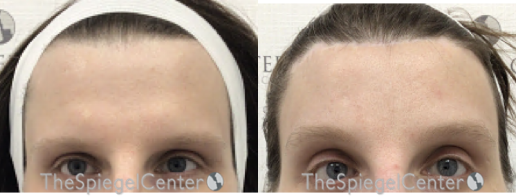 Browlift / Fox Eye Lift Before & After Photos | The Spiegel Center
