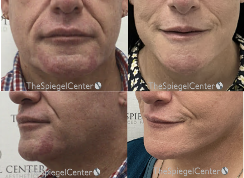 Mandible Contouring Before & After Photos | The Spiegel Center