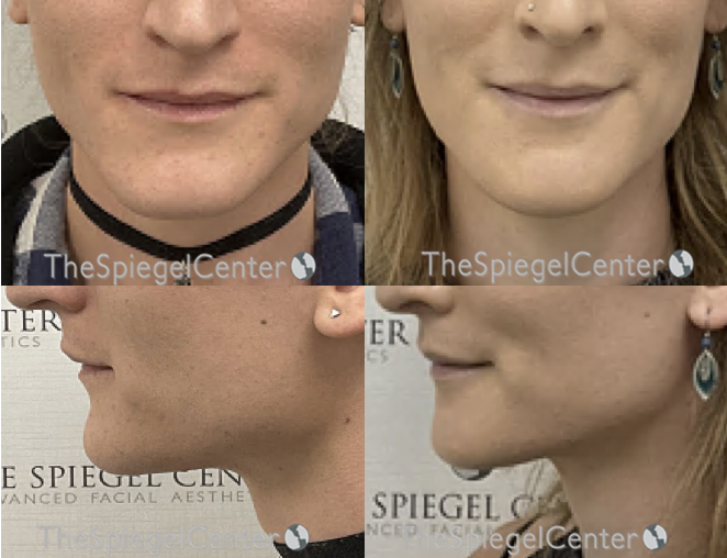 Mandible Contouring Before & After Photos | The Spiegel Center