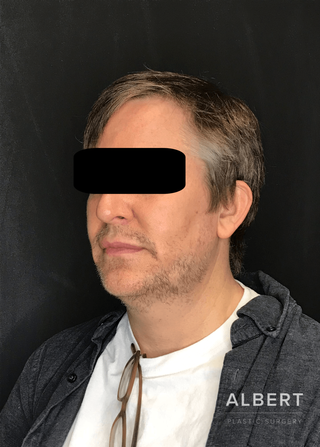 Patient 151452148 | Liposuction Before & After Photos | Albert Plastic ...