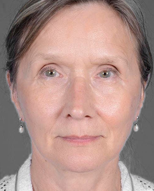 Patient 151452110 | Facelifts / Necklift Before & After Photos | Albert ...