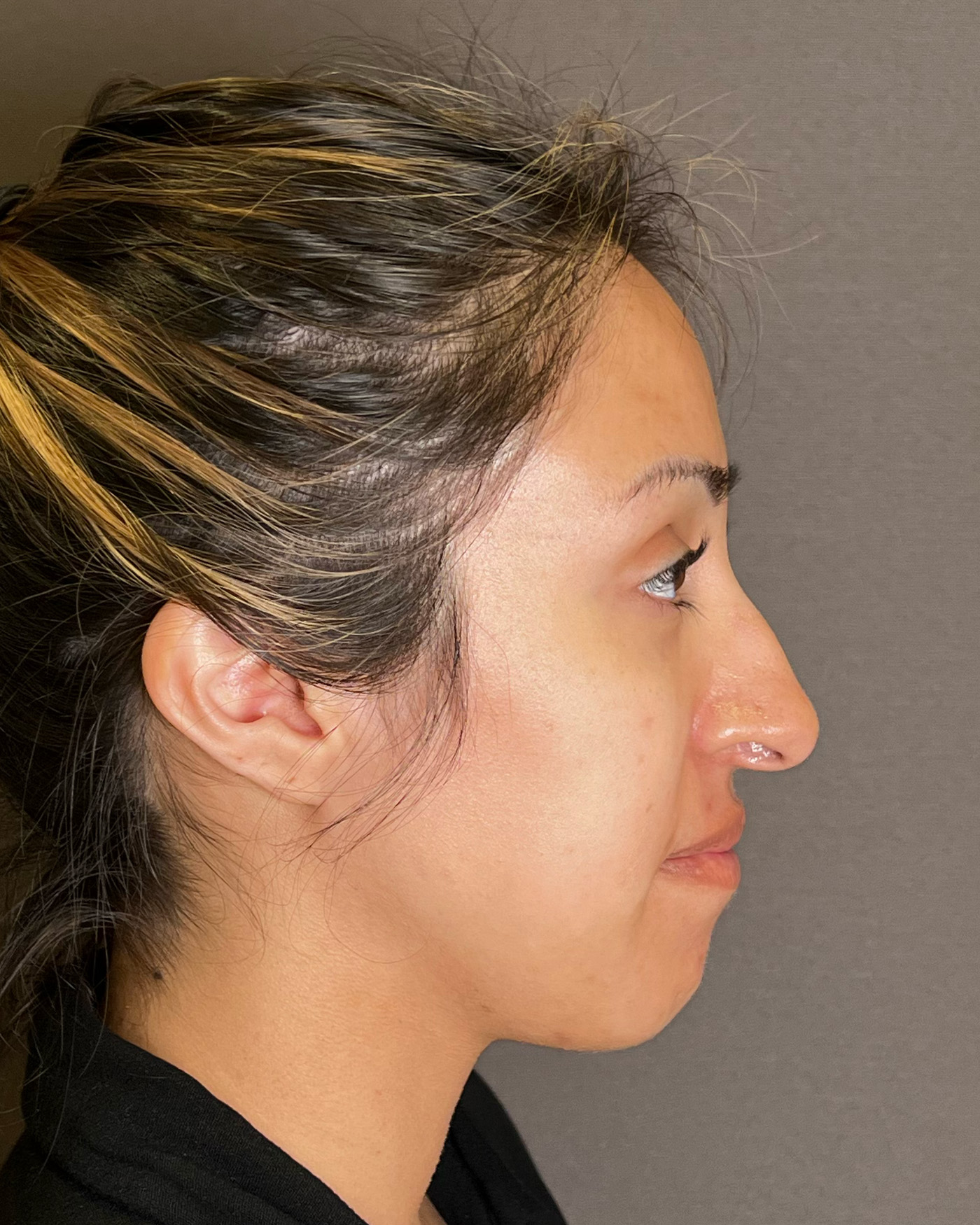 Nose Job Before And After Profile