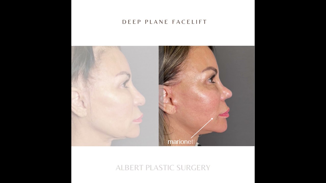 Deep Plane Facelift in NYC | Albert Plastic Surgery