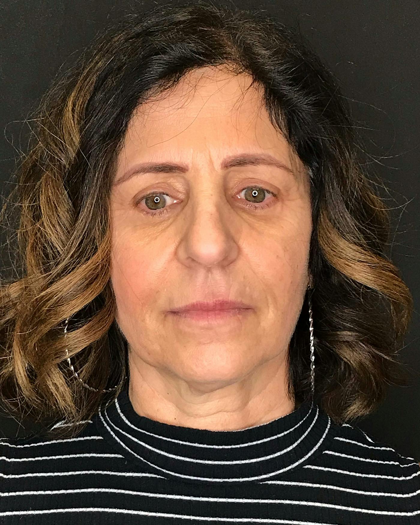 Patient 830010 | Facelifts / Necklift Before & After Photos | Albert ...