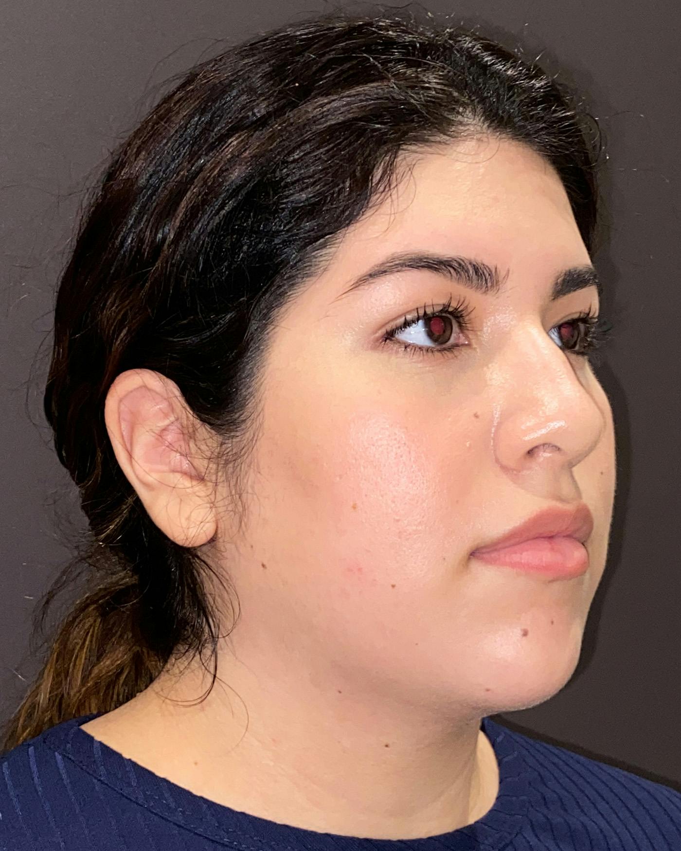 Patient 286332 | Facelifts / Necklift Before & After Photos | Albert ...