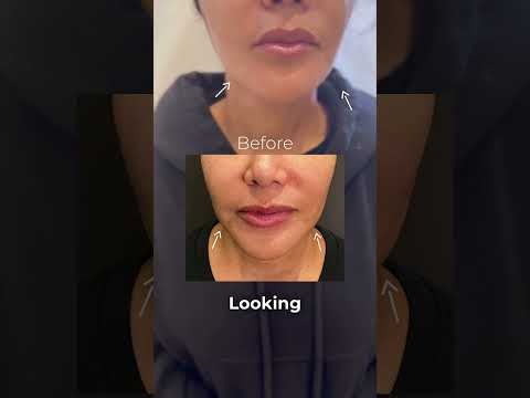 Nanolift™ | Albert Plastic Surgery