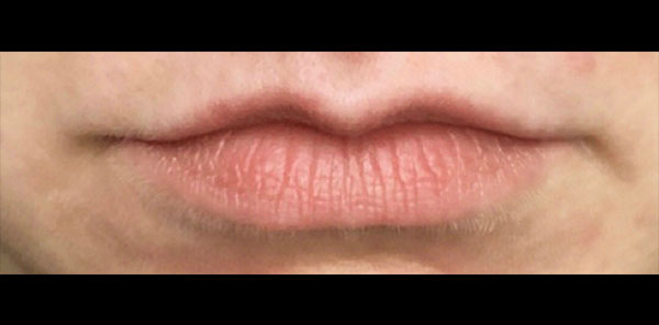 White People Lips