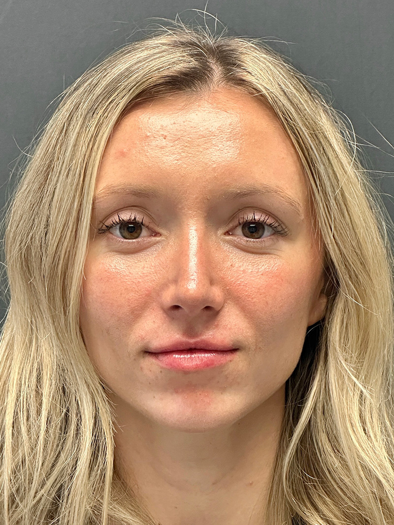 Chin Augmentation Miami | Paul Afrooz Plastic Surgery