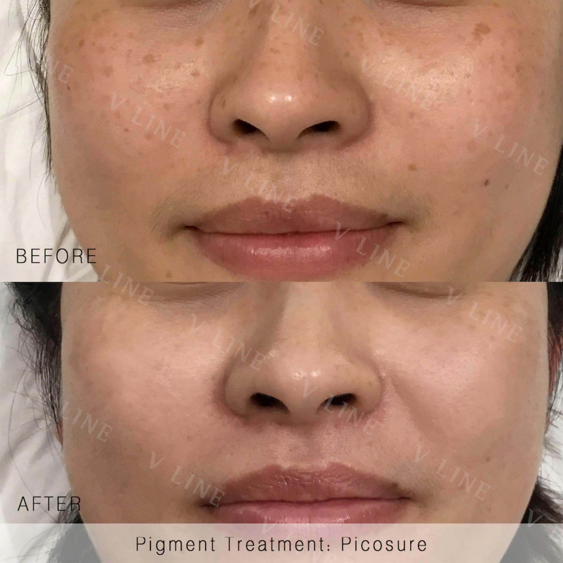 Patient 133227619 | Picosure Before & After Photos | V Line Cosmetic Center