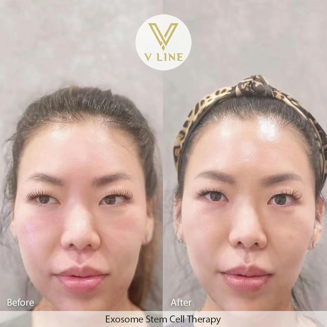 Patient 133235922 | Exosome Therapy Before & After Photos | V Line ...