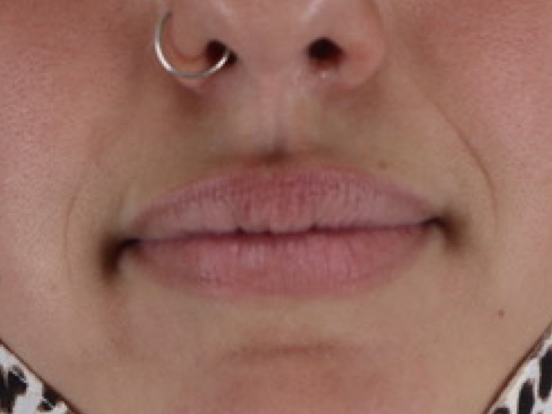 Labret Piercing Scar