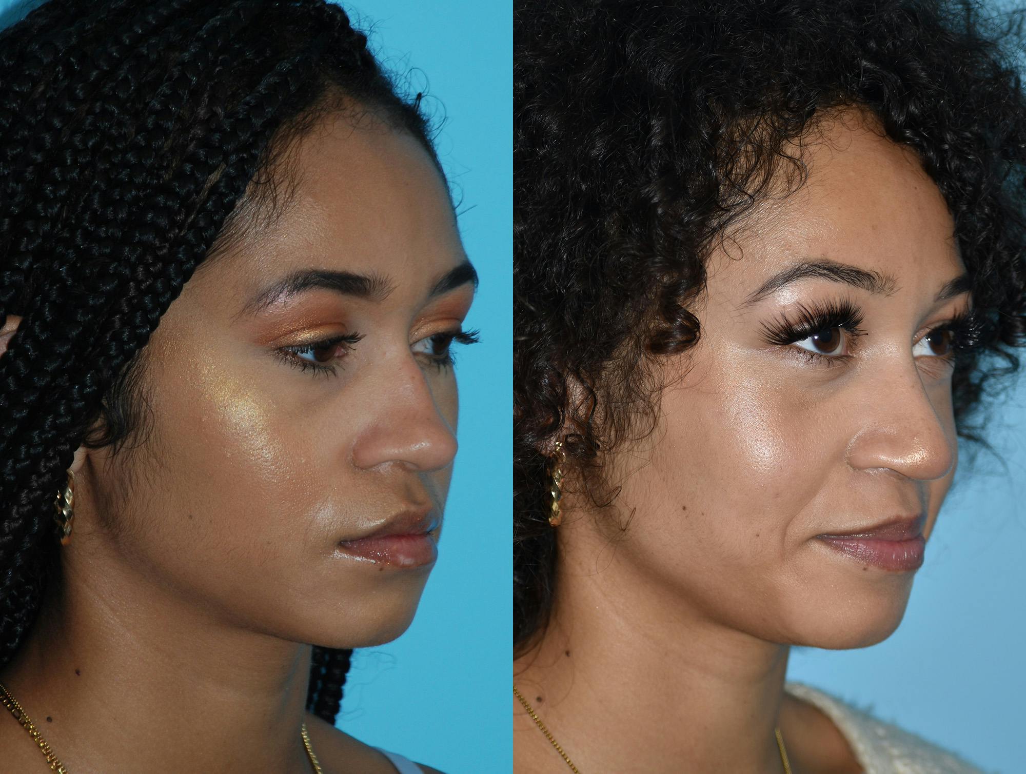 Patient 180383015 Rhinoplasty Before And After Photos Chevy Chase