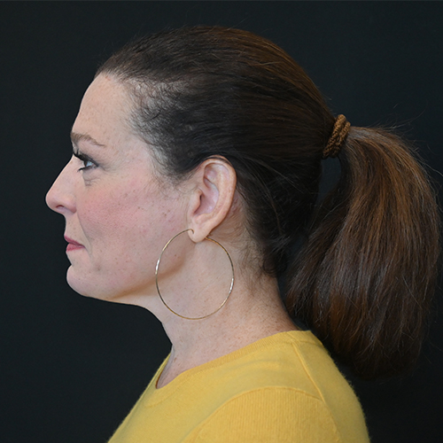 Patient 114721138 | FaceTite by InMode Before & After Photos | Vivify ...