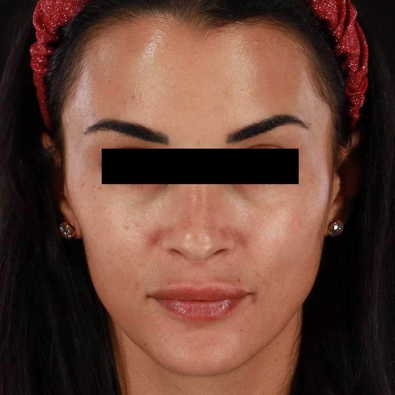 Patient 179898292 | Dermal Fillers Before & After Photos | Vivify Plastic Surgery