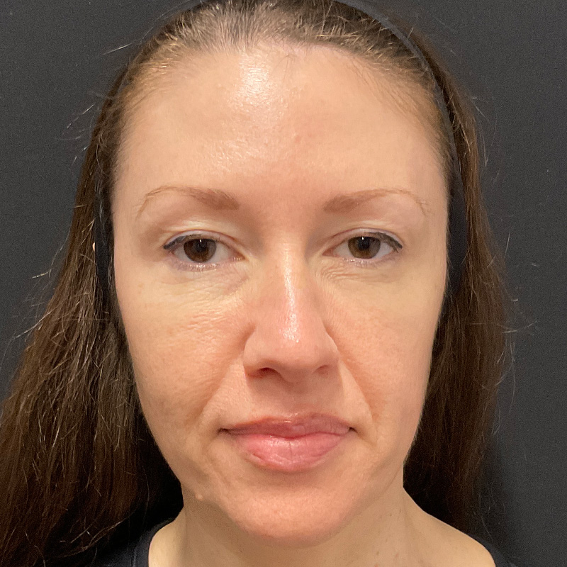 Patient 201484979 | HALO™ Laser Treatment Before & After Photos | Vivify Plastic Surgery