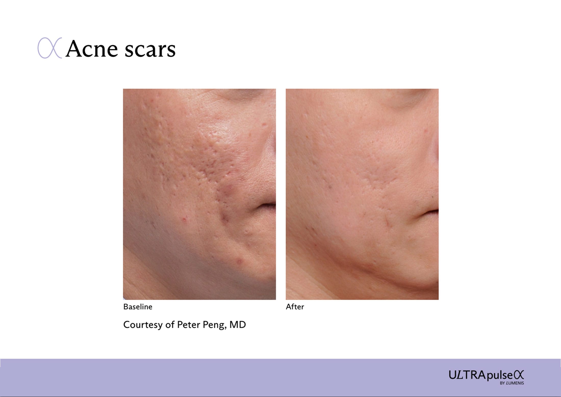 ULTRAPulse® Alpha Laser in Tampa, FL | Vein & Aesthetics