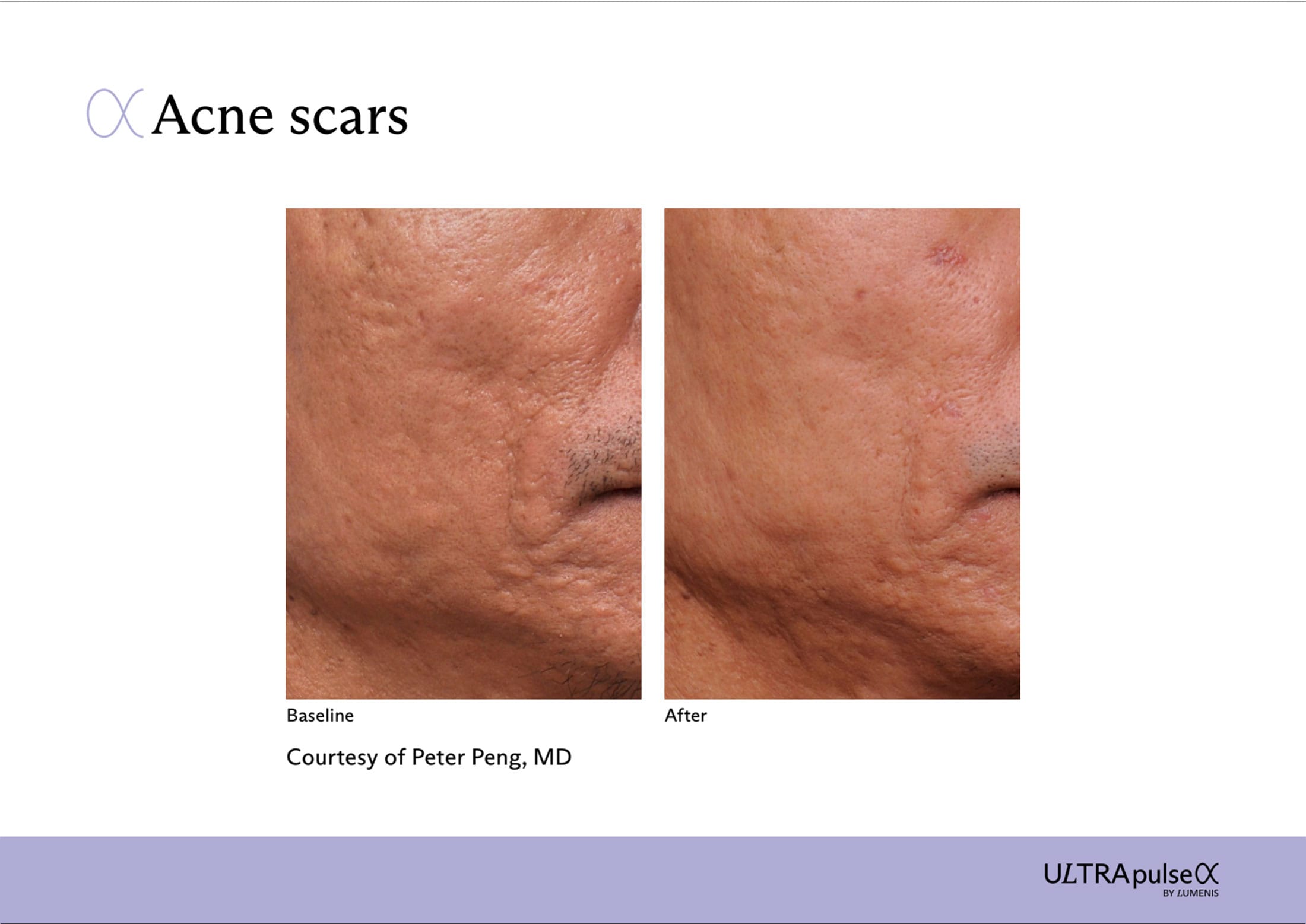 ULTRAPulse® Alpha Laser in Tampa, FL | Vein & Aesthetics