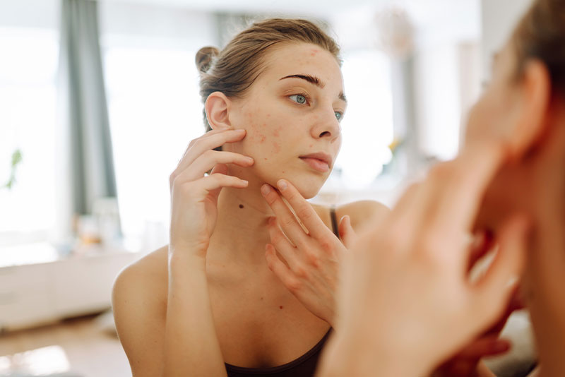 Why Do Acne Scars Form and What Can You Do About Them?