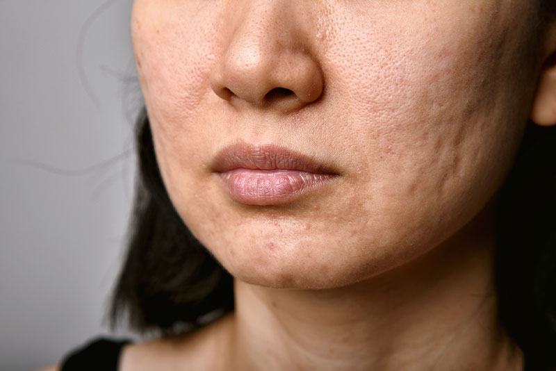 Treating Deep Acne Scars and Severe Skin Damage with CO₂ Resurfacing ...