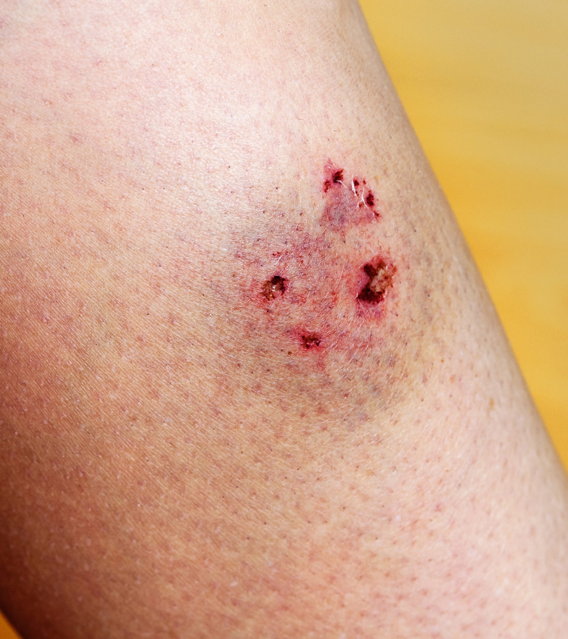 Dog Bite Attorney Tampa | Carlson, Meissner & Hayslett P.A.